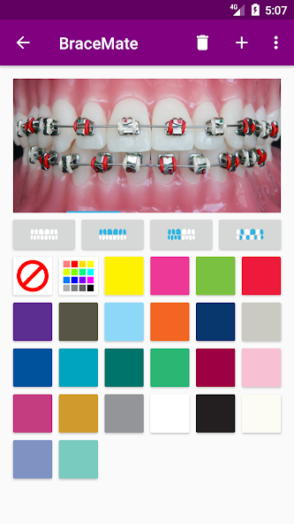 Braces Filter: Know How You Look with Braces [App & Online]